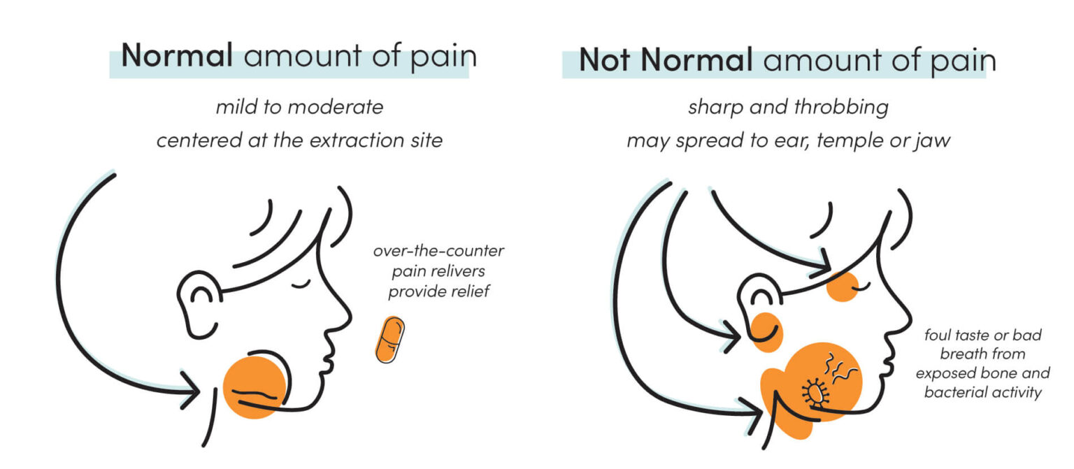 How to Know If You Have Dry Socket: Clear Symptoms and Signs Explained ...