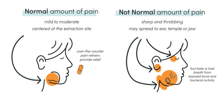 How to Know If You Have Dry Socket: Clear Symptoms and Signs Explained ...