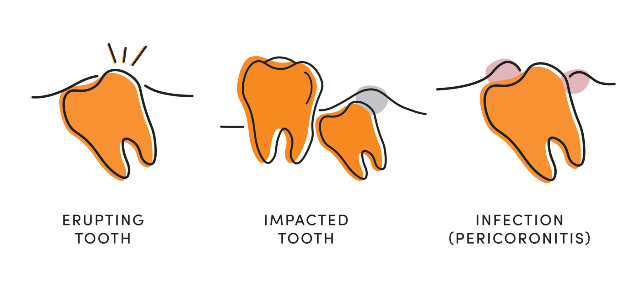 10 Effective Home Remedies for Wisdom Tooth Pain (Fast Relief) - Dentistry