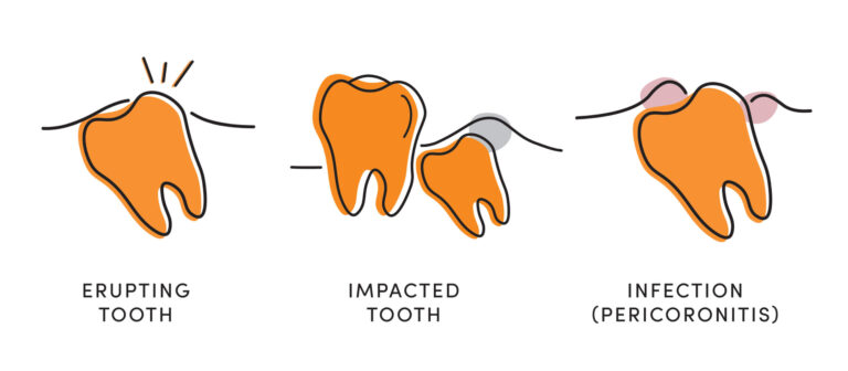 10 Effective Home Remedies for Wisdom Tooth Pain (Fast Relief) - Dentistry