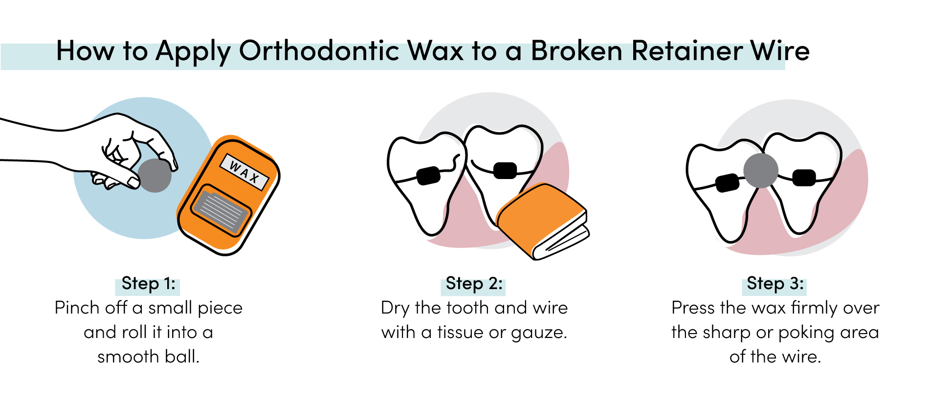 Broken Permanent Retainer: Is It a Dental Emergency? - Dentistry