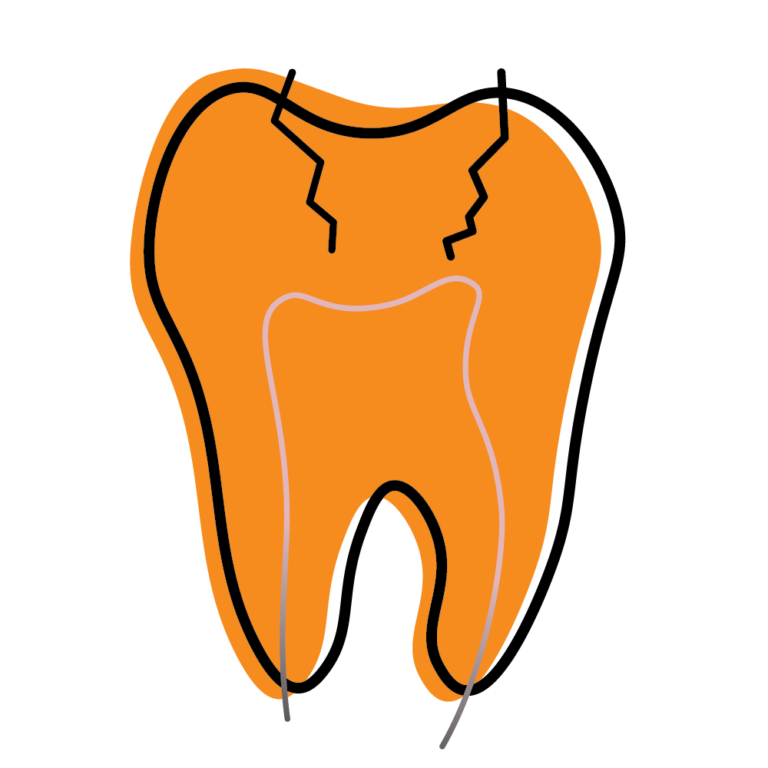 Guide to Cracked Tooth Symptoms and Treatment - Dentistry